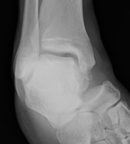 Subtalar Dislocation | The Bone School